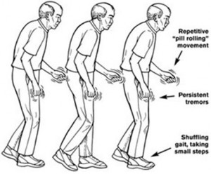Enfermedad de Parkinson – Fisioterapia Magallanes | Clinica de ...